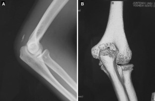 Triceps tendon avulsion: a case report and discussion about the ...