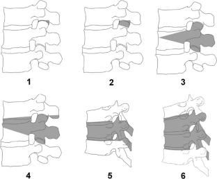 Osteotomies in the treatment of spinal deformities: indications ...