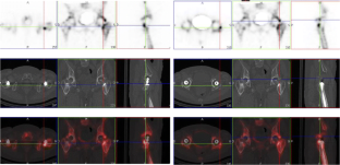 Bone scan usefulness in patients with painful hip or knee prosthesis ...