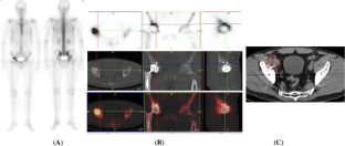 Bone scan usefulness in patients with painful hip or knee prosthesis ...