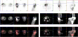 Bone scan usefulness in patients with painful hip or knee prosthesis ...