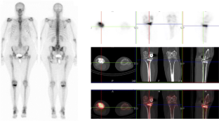 Bone scan usefulness in patients with painful hip or knee prosthesis ...
