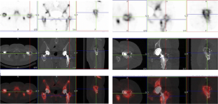 Bone scan usefulness in patients with painful hip or knee prosthesis ...