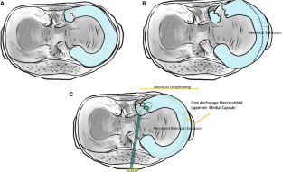 Arthroscopic direct meniscal extrusion reduction: surgical tips to ...