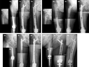 The inverted Vancouver C fracture. Case series of unstable proximal ...