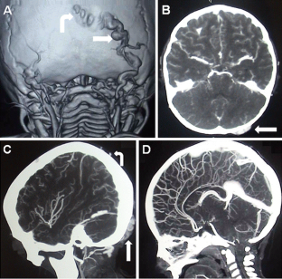 Sinus pericranii with unusual features: multiplicity, associated dural ...