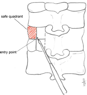 How I do it: cervical lateral mass screw fixation | SpringerLink