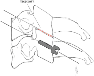How I do it: cervical lateral mass screw fixation | SpringerLink