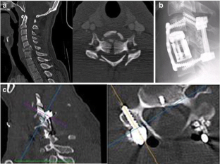 How I do it: cervical lateral mass screw fixation | SpringerLink