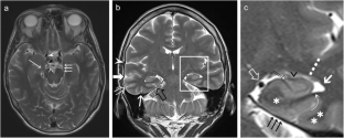 Anterior temporal lobectomy | SpringerLink