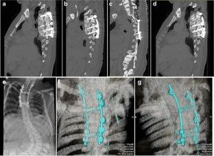 Osteopathia striata with cranial sclerosis (OSCS): review of the ...