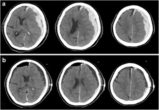 Flexible endoscopically assisted evacuation of acute and subacute ...