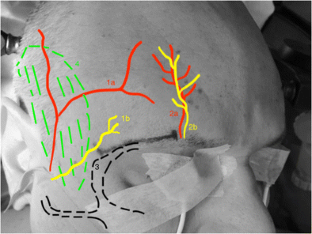 Supraorbital approach through eyebrow skin incision for aneurysm ...