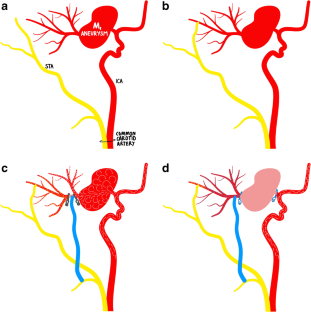 Protective STA-MCA bypass to prevent brain ischemia during high-flow ...