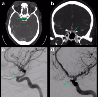 Surgical clipping of a non-ruptured ophthalmic aneurysm through an ...