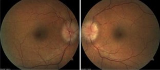 Patient with idiopathic intracranial hypertension with progressive ...