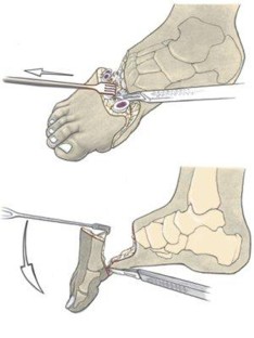 Amputationstechniken der unteren Extremität bei Patienten mit pAVK ...