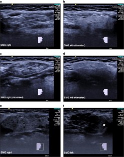 Removal of stones from the superficial lobe of the submandibular gland ...