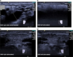 Removal of stones from the superficial lobe of the submandibular gland ...