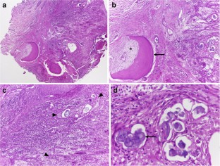 Eruption sequestrum: an inflamed odontogenic hamartoma | SpringerLink