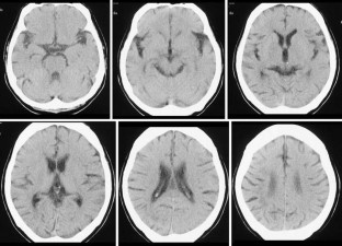 Lymphomatosis cerebri: clinical characteristics, neuroimaging, and ...
