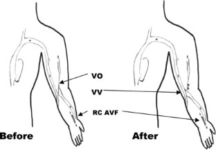 Venovenostomy for Outflow Venous Obstruction in Patients with Upper ...