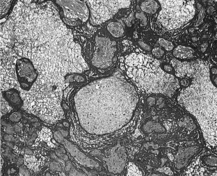 Placental Infarcts, Intervillous Fibrin Plaques, and Intervillous ...