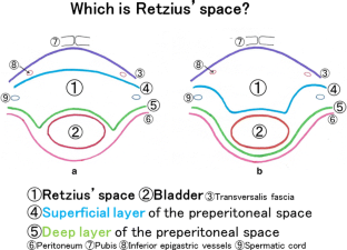 Paradigm shift regarding the transversalis fascia, preperitoneal space ...