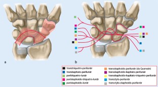 Perilunäre Luxationen und Luxationsfrakturen an der Handwurzel ...