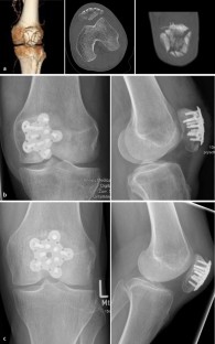 Patellafrakturen | SpringerLink