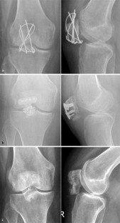 Patellafrakturen | SpringerLink