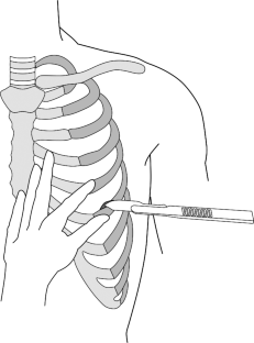 Thoraxtrauma und Thoraxdrainage: Diagnostik und Therapie—Ein systematisches Review | SpringerLink