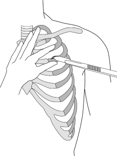 Thoraxtrauma und Thoraxdrainage: Diagnostik und Therapie—Ein systematisches Review | SpringerLink