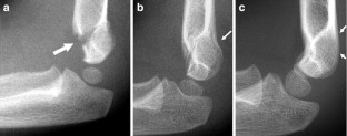 The angled buckle fracture in pediatrics: a frequently missed fracture ...