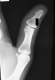 Acute calcific periarthritis of the hand and wrist: a series and review ...