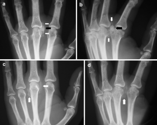 Acute calcific periarthritis of the hand and wrist: a series and review ...