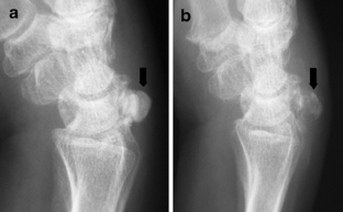 Acute calcific periarthritis of the hand and wrist: a series and review ...