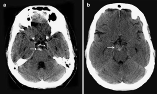CT evaluation of subarachnoid hemorrhage: a practical review for the ...