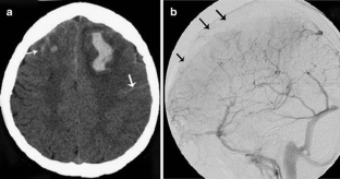 CT evaluation of subarachnoid hemorrhage: a practical review for the ...
