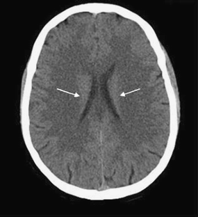 Caudate body (CB) sign: New early CT sign of hyperacute anterior ...