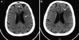 Caudate body (CB) sign: New early CT sign of hyperacute anterior ...