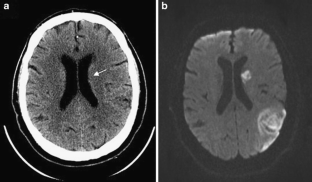 Caudate body (CB) sign: New early CT sign of hyperacute anterior ...