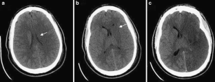 Caudate body (CB) sign: New early CT sign of hyperacute anterior ...
