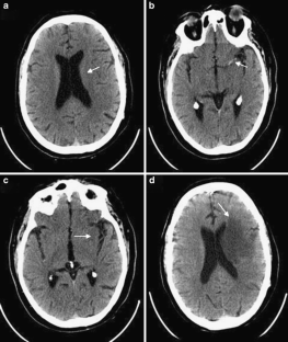 Caudate body (CB) sign: New early CT sign of hyperacute anterior ...