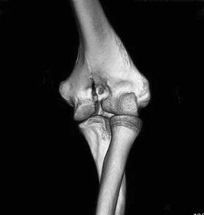Medial condyle fracture of the distal humerus in an adolescent with pre ...