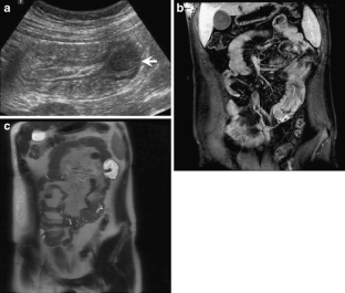 Intussusception in adults: what radiologists should know | SpringerLink