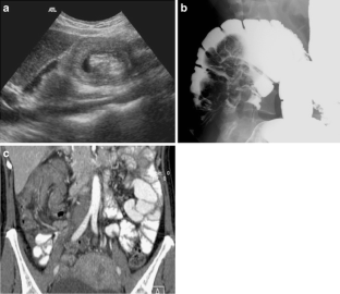 Intussusception in adults: what radiologists should know | SpringerLink