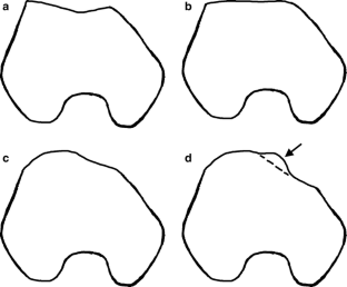 Transient lateral patellar dislocation: review of imaging findings ...
