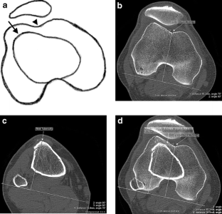 Transient lateral patellar dislocation: review of imaging findings ...