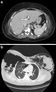 Clinical implications of immediate or later periportal edema in MS-CT ...